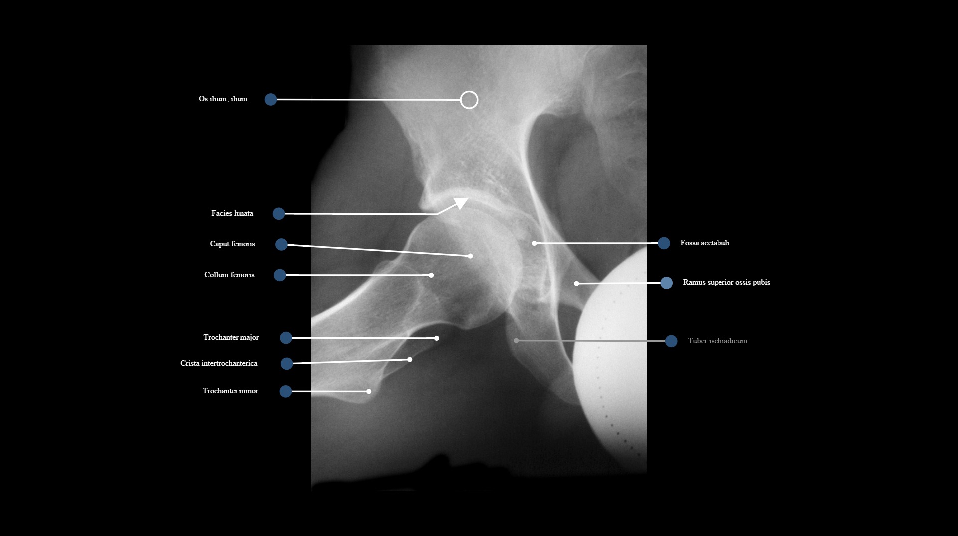 Axial X Ray Picture Of The Hip Joint